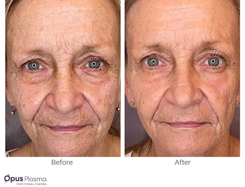 Everything You Need To Know About The Opus Plasma Skin Resurfacing ...